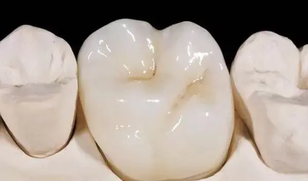 Advantages and Disadvantages of Zirconia Crown | AVF Dental Group